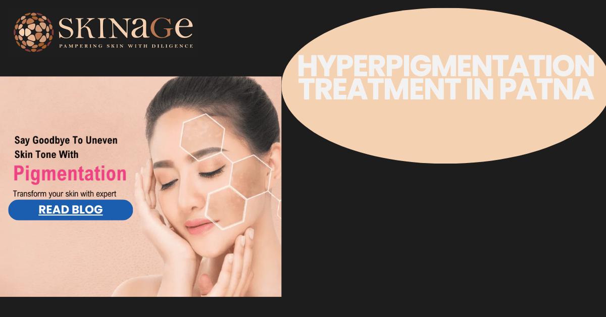 Hyperpigmentation Treatment in Patna: Skinage Clinic - SKINaGe ...